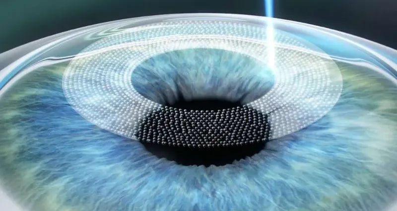 LASIK vs PRK – Key Differences & Recovery Tips – Optiview Eye Clinic